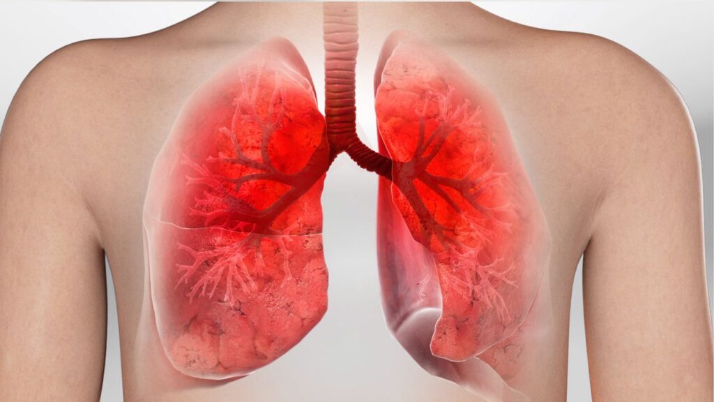 Bronchitis - The Homeopathy
